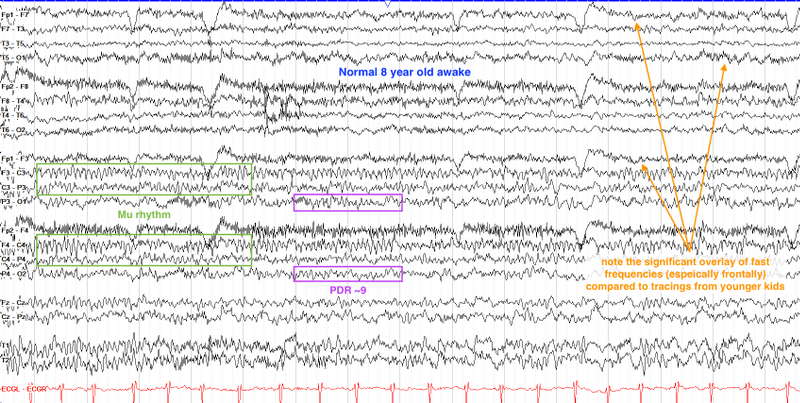 The Pediatric Eeg